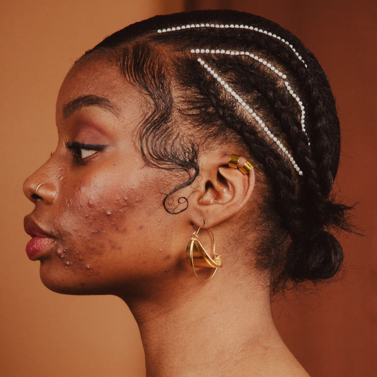 Acne – MySkinPlug